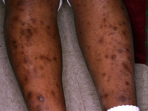 Photos Of Bed Bug Bites On African American Skin