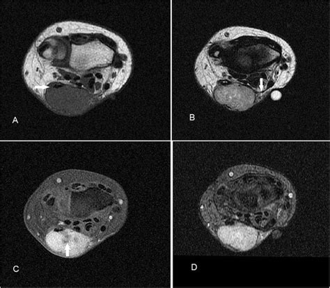 Nodular Fasciitis In A 39 Year Old Female Presenting With A Rapidly Download Scientific Diagram