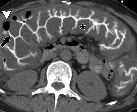 Pseudomembranous Colitis X Ray