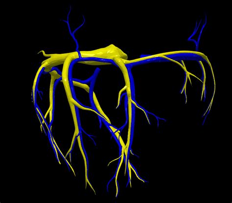 3d Model Of Partial Anomalous Pulmonary Venous Connection By Azekapeka