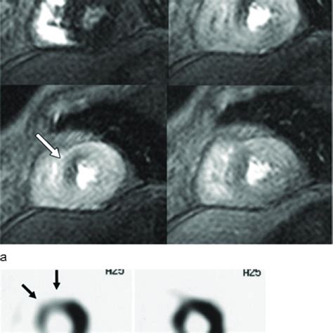First Pass Contrast Enhanced Multishot Echo Planar Stress Mr Images Download Scientific Diagram
