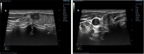 The Right Thyroid Nodule With The Maximum Diameter Of 11 Mm In A