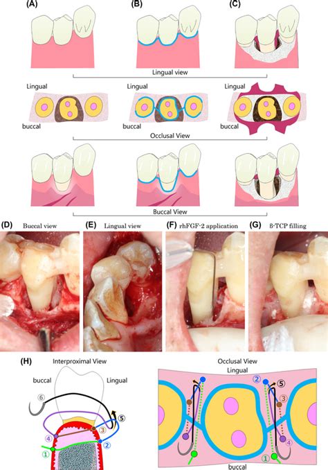 Periodontal Regenerative Therapy Using A Simplified Papilla