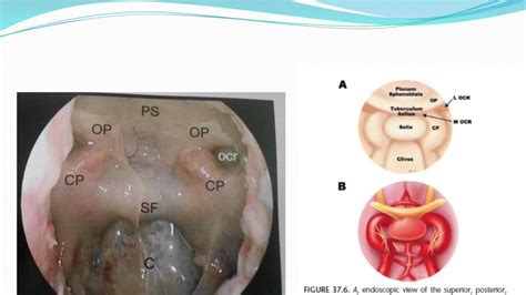 Steps Of Endonasal Endoscopic Pituitary Macroadenoma Surgery Youtube