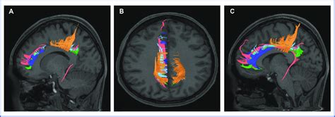 Combined Structural Connectivity Of The Posterior Cingulate Cortex Download Scientific Diagram