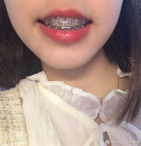 Braces Loveおしゃれまとめの人気アイデアPinterestThebraceslove 美