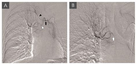 Selective Angiography And Super Selective Bronchial Artery Embolization Download Scientific