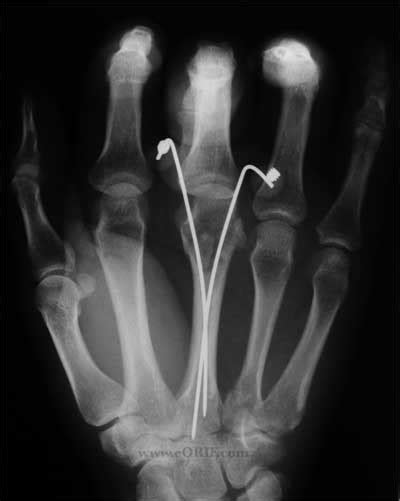 Metacarpal Neck Fracture ORIF CRPP 26615 EORIF