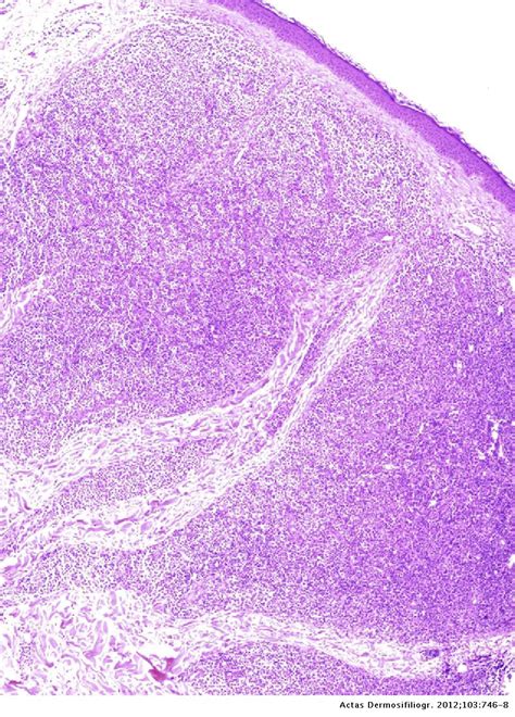 Cutaneous B Cell Lymphoma The Importance Of Clinicopathologic Correlation Actas Dermo
