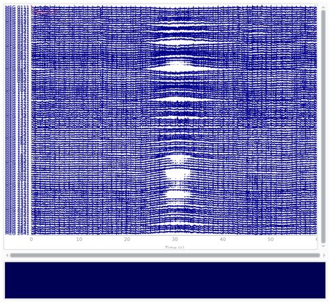 Overview Of Artifact Detection — Mne 1 0 3 Documentation