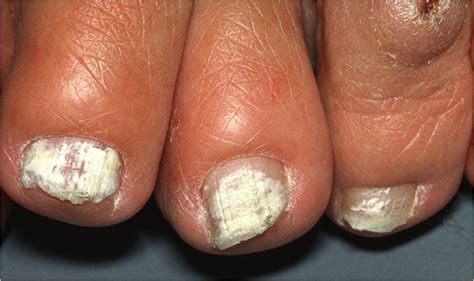 Onychomycosis Tinea Unguium Nail Fungal Infection Dermatology Advisor