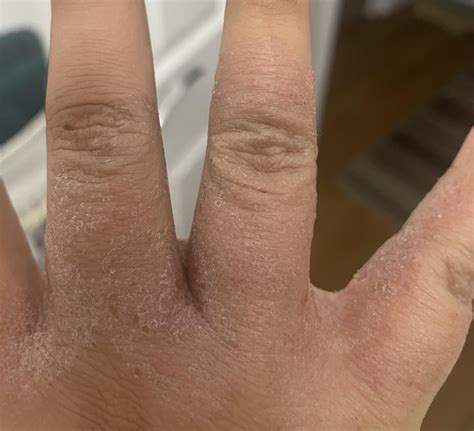 Eczema Or Scabies Crusted Rscabies