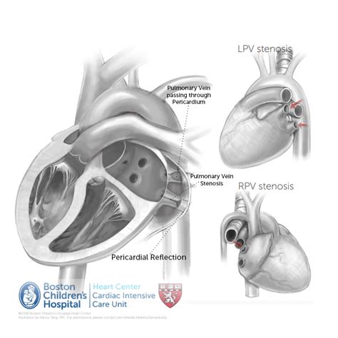 Pvs 1 Online Supplement Pvs 1 Online Supplement