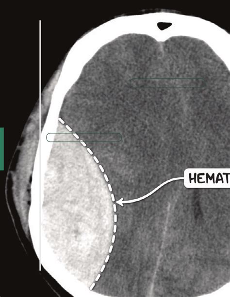 Brain Ischemia Notes Diagrams And Download Pdf Osmosis