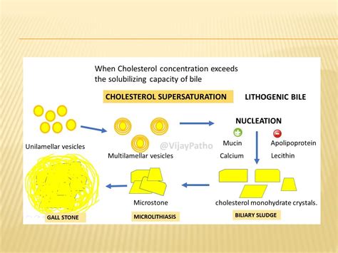 Cholelithiasis Clinical Features Treatment Pptx
