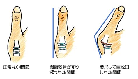 親指の付け根が動かすと痛い！それは母指cm関節症かもしれません すみだ整骨院 直方 飯塚 田川 八幡で整骨院なら