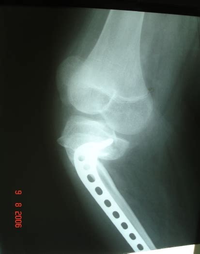Lateral View With Marked Procurvatum Deformity Download Scientific Diagram Lateral View With Marked Procurvatum Deformity Download Scientific Diagram