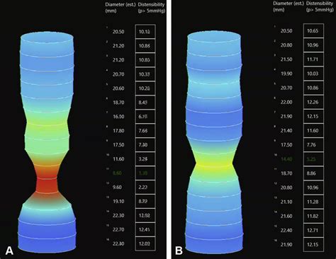 Endoflip Topography Of Case 1 At A Volume Of 60 Ml A Pre Poem