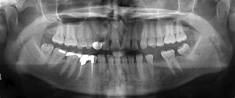 Dental Caries Detection Object Detection Model By Capstone B