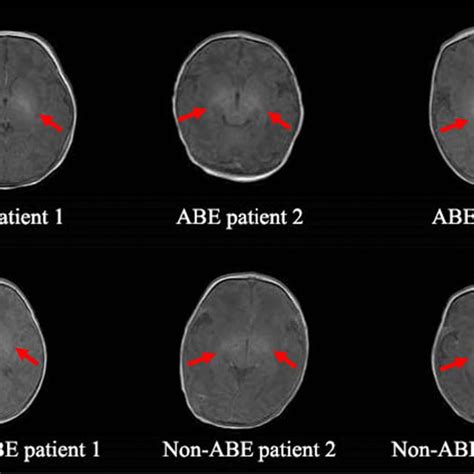 Bind Score Serum Bilirubin And Bilirubin Albumin Ratio Download Scientific Diagram