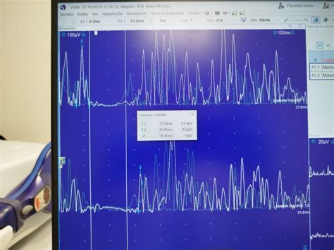 Ovidiu Banea On Linkedin The Masseter Cutaneous Silent Period Cusp