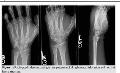 Hamate Dislocation