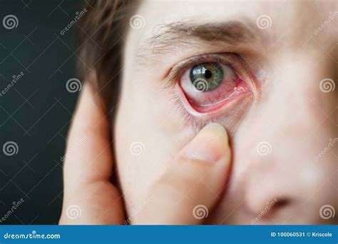 Mens Red Eye Close Up Fatigue Problems With Blood Vessels Stock Image