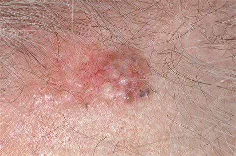 Basal Cell Carcinoma On A Womans Forehead Stock Image C0601991 Science Photo Library
