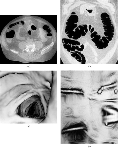 Ct Colonography Methods Pathology And Pitfalls Clinical Radiology