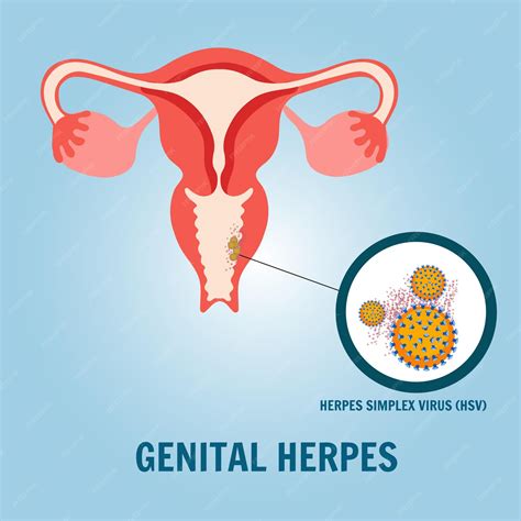 Premium Vector Medical Picture Genital Herpes In Vector Illustration
