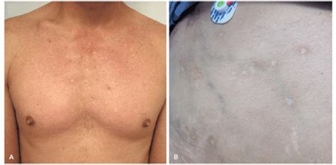 Hypopigmented Scars Plastic Surgery Key