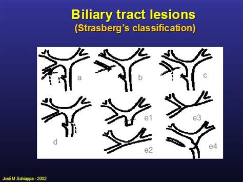 Biliary Tract Lesions Strasbergs Classification