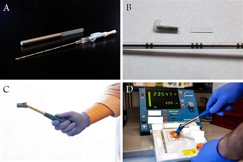 Radioactive Seed Localization Is A Safe And Effective Tool For Breast
