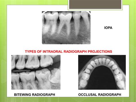 Paralleling And Bisecting Radiographic Techniques Pptx Dental Health Diseases And Conditions