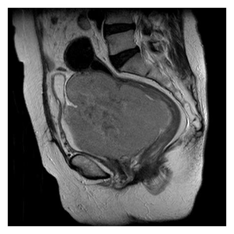 Sagittal T2 Weighted Magnetic Resonance Imaging Showing A Large Pelvic