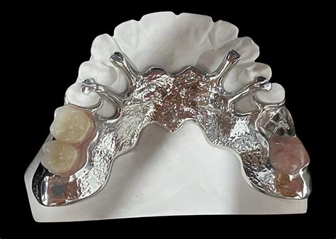 Customizable Cast Partial Removable Denture With Acrylic Resin Metal