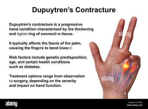 A 3d Medical Illustration Displaying A Patients Hand With Dupuytrens Contracture Emphasizing