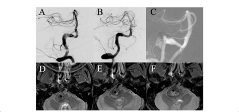 A Digital Subtraction Angiography Dsa Showed The Right Vertebral