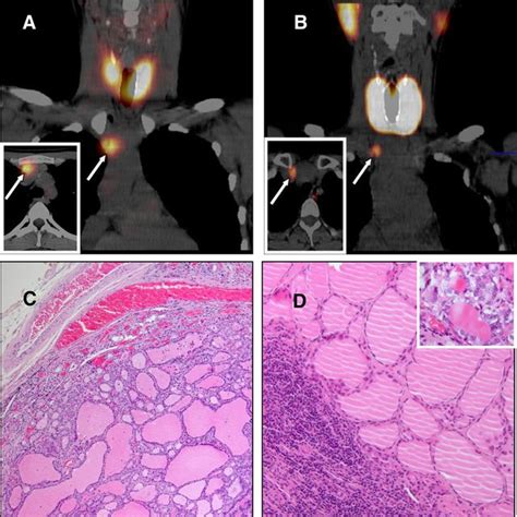 99m Tc Positive Ectopic Thyroid Tissue In The Right Retrosternal Region Download Scientific