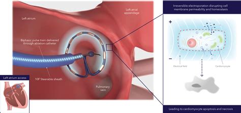 Pulsed Field Ablation For The Treatment Of Atrial Fibrillation Pulsed Af Pivotal Trial