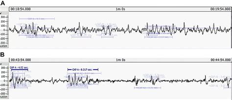 Visual And Automatic Classification Of The Cyclic Alternating Pattern In Electroencephalography