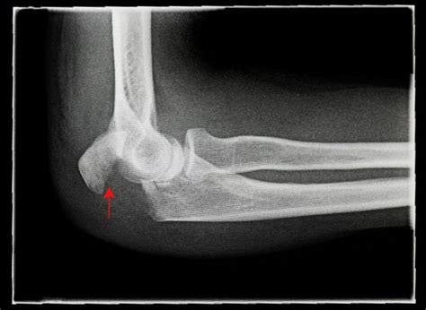 Imageolecranon Fracture Msd Manual Professional Edition