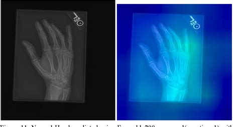 Figure 11 From Abnormality Detection In Musculoskeletal Radiographs With Convolutional Neural