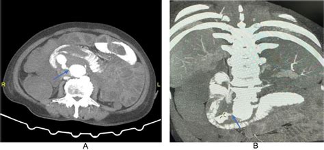 Infrarenal Fusiform Aaa With A Size Of 75 × 53 Mm In A 73 Year Old