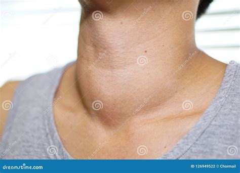 Asian Lady Woman Patient Have Abnormal Enlargement Of Thyroid Gland