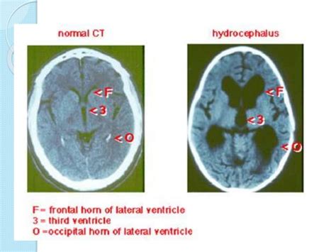 Normal Brain Ct Scan Vs Hydrocephalus Explained Pptx Brain And Nervous System Disorders