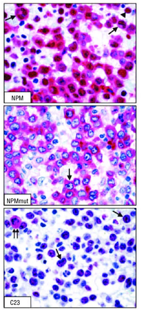 Aberrant Cytoplasmic Expression Of Npm In Npmc Aml Top Nuclear