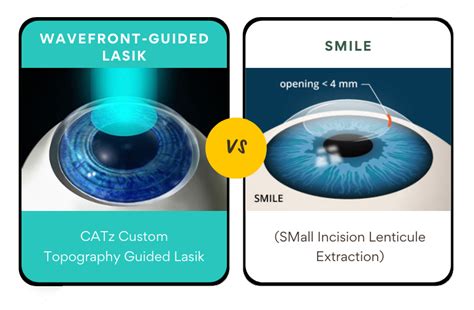 Smile Vs Wavefront Guided Lasik Top Michigan Lasik Eye Surgery Yaldo Eye Center 248 553
