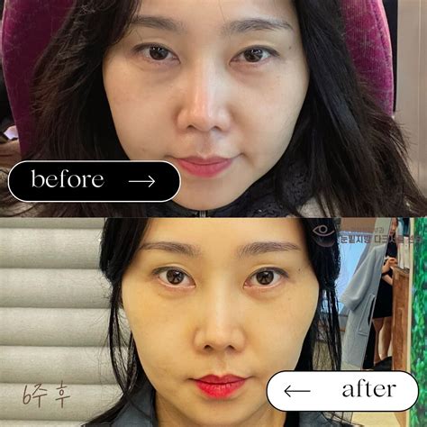 도곡 비절개눈밑지방재배치 전후사진이 궁금하다면 ⁉️ 도곡 예미원으로 오세요 ☺️ 아주 자연스러운 눈매를 완성시켜주는