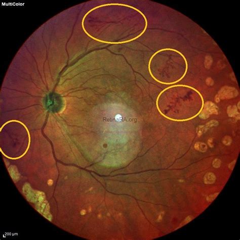 Multimodal Imaging Of Retinal Neovascularization Secondary To Proliferative Diabetic Retinopathy